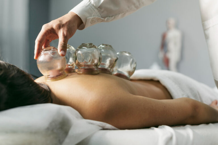 Cupping Calgary - Riverbend Physiotherapy & Neuro Rehab Clinic